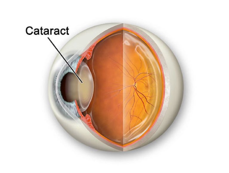 Professor Rupert Bourne – Consultant Ophthalmic Surgeon