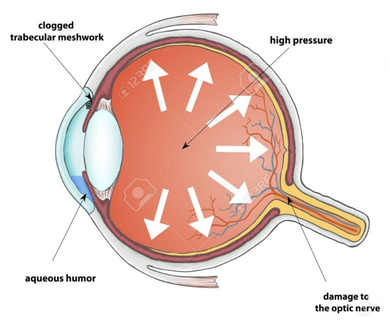 Professor Rupert Bourne – Consultant Ophthalmic Surgeon